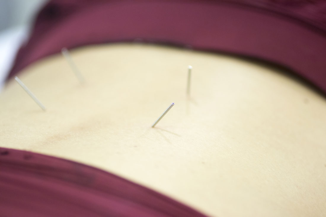 Dry Needling Therapy in Lisburn | Dry Needling Therapy in Belfast ...